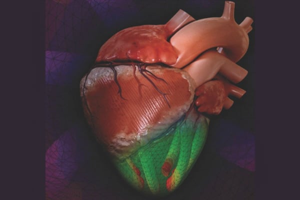 Soft Robotic Cardiac Device Prevents Heart Failure - News