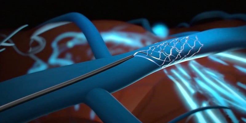 Startup Leaps Ahead of Neuralink With First Human BCI Implant - News